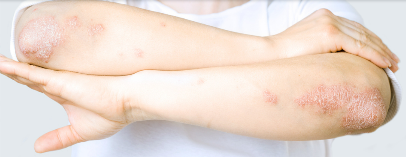 Psoriaza (luskavica) - nastanek in zdravljenje, nega kože | Top Medicus